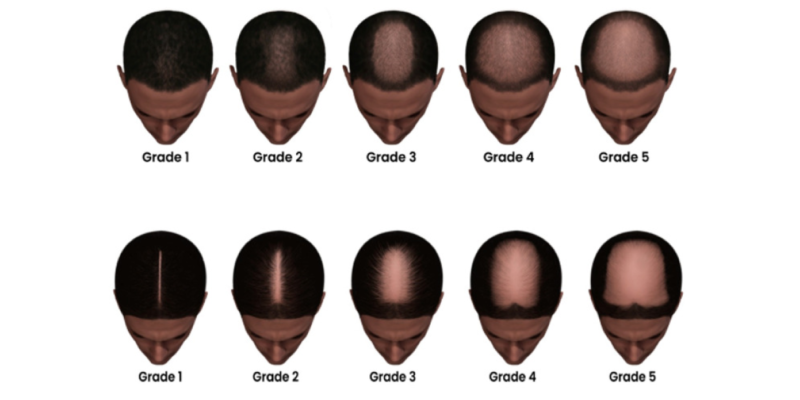 Top 8 Signs of Balding: How to Spot It Early and What It Means